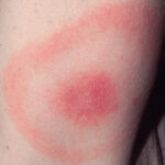 Remove Ticks Safely – Ticks & Lyme Disease